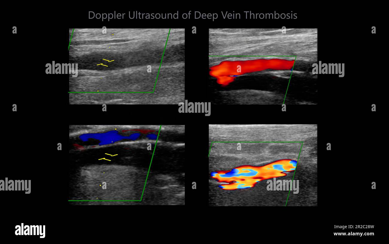 Color Doppler ultrasound determination in deep vein thrombosis patients ...