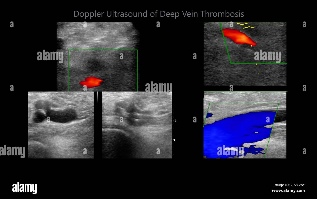 Color Doppler ultrasound determination in deep vein thrombosis patients ...