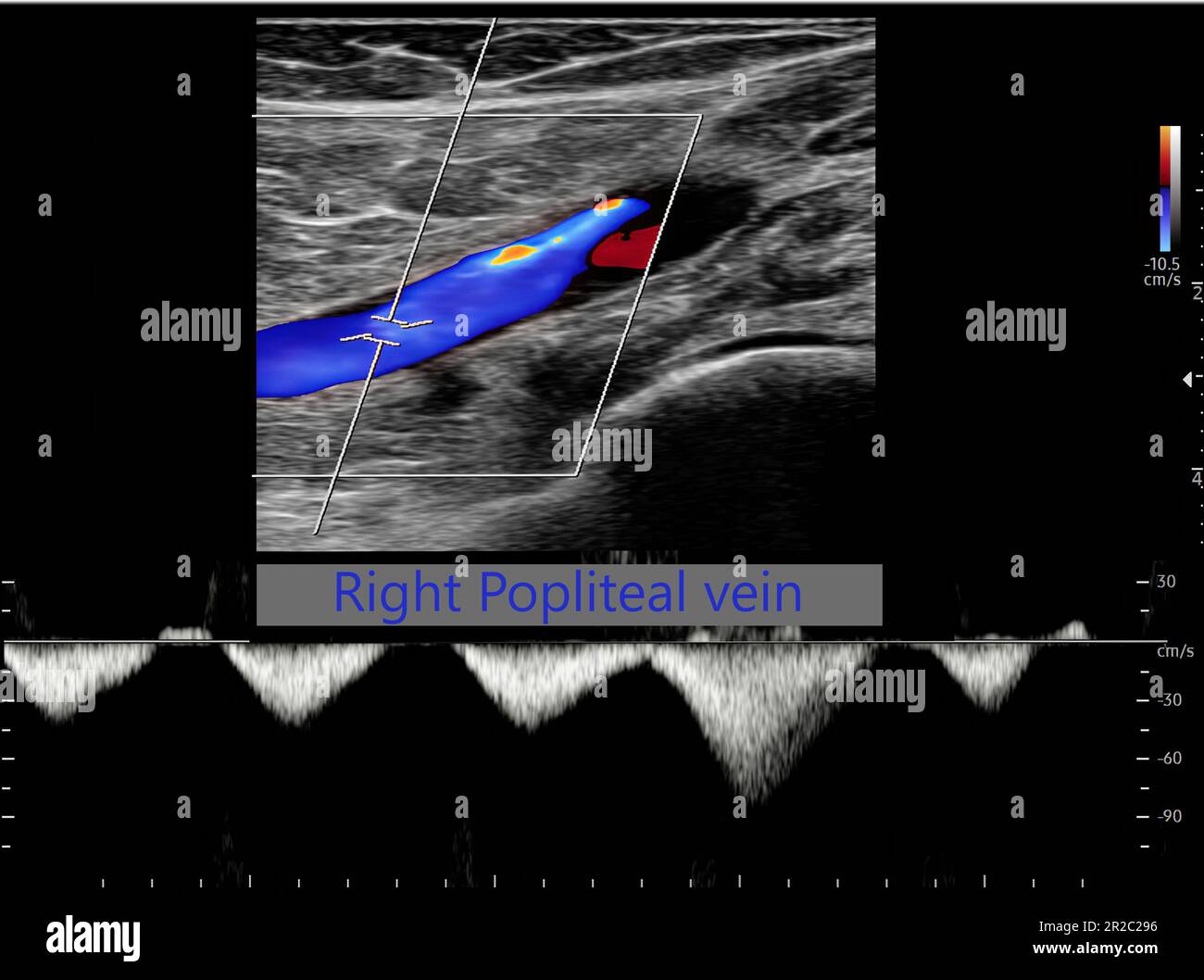 Color Doppler ultrasound determination in deep vein thrombosis patients ...