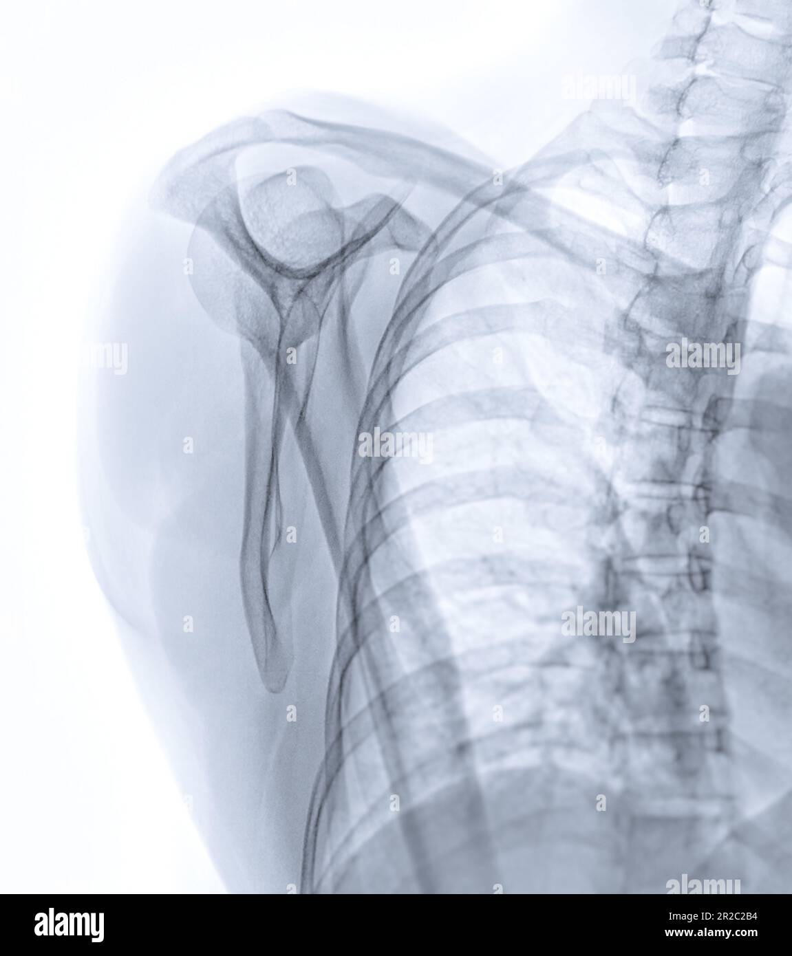 Normal shoulder x ray hi-res stock photography and images - Alamy