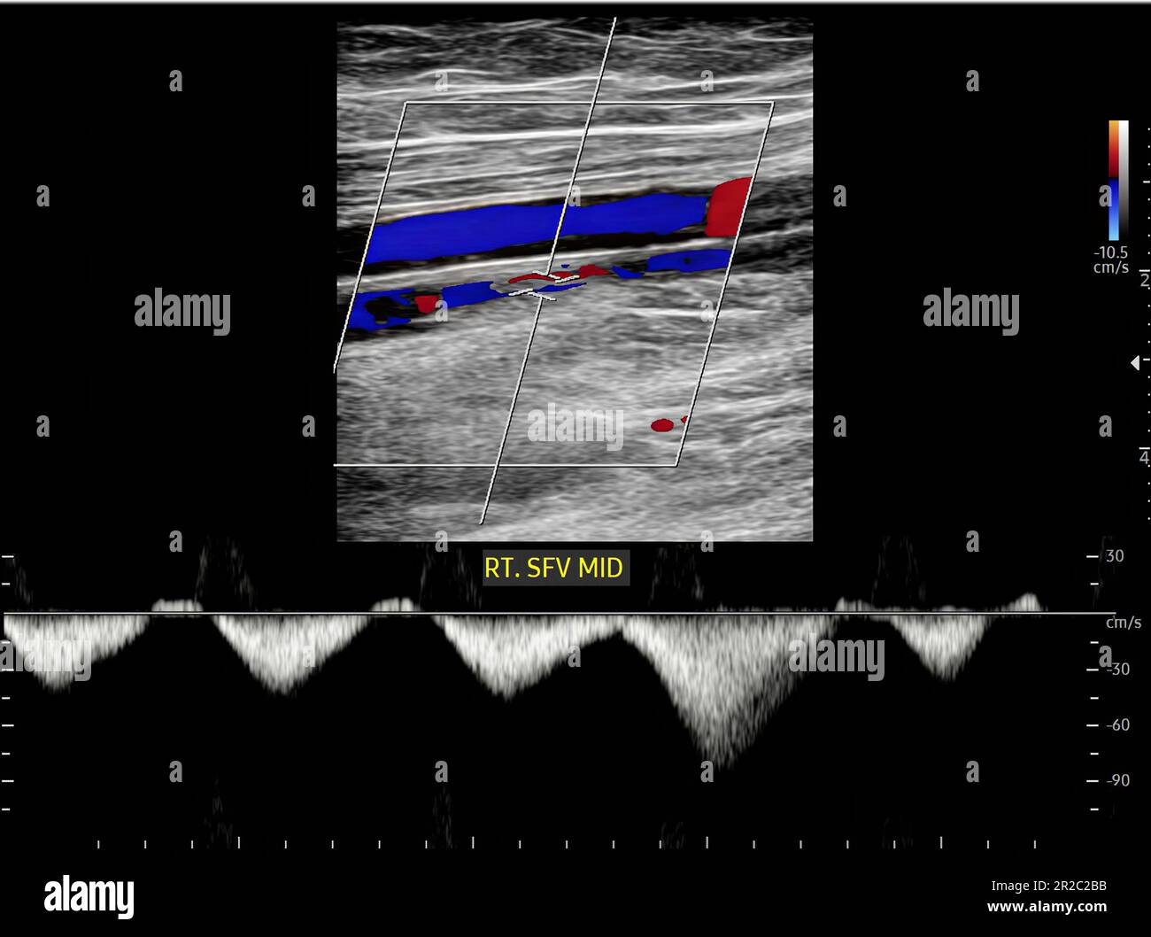 Doppler Ultrasound In Deep Vein Thrombosis Ppt - vrogue.co Doppler Ultrasound In Deep Vein Thrombosis Ppt - vrogue.co