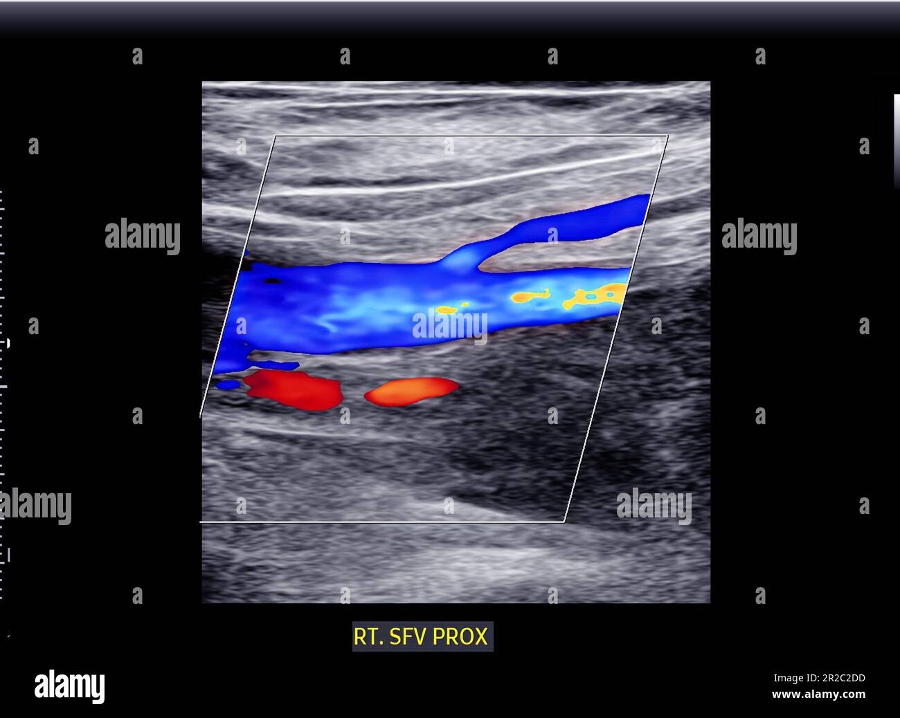 Color Doppler ultrasound determination in deep vein thrombosis patients ...