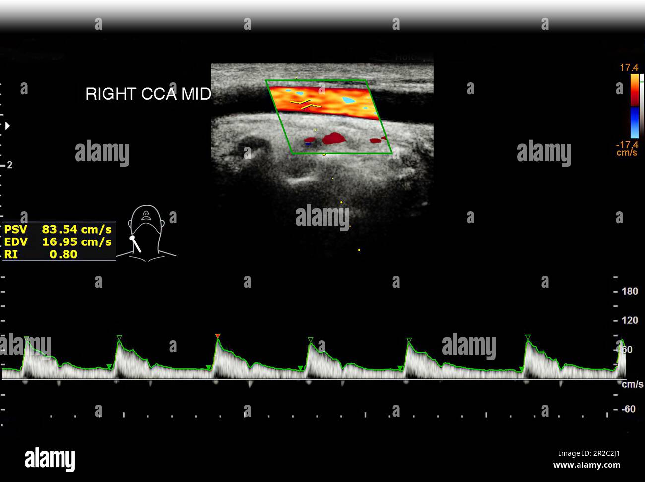 A carotid artery Doppler ultrasound is a diagnostic test used to check ...