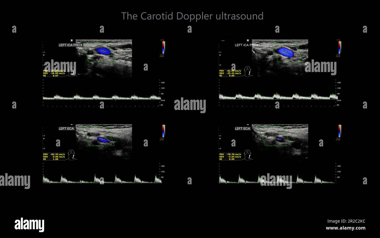 A carotid artery Doppler ultrasound is a diagnostic test used to check ...