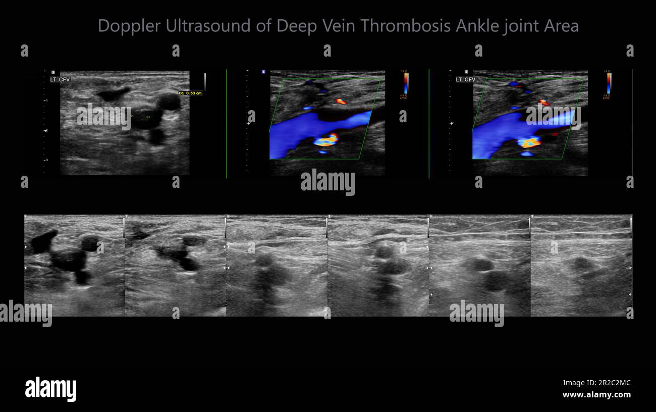 Color Doppler ultrasound determination in deep vein thrombosis patients ...