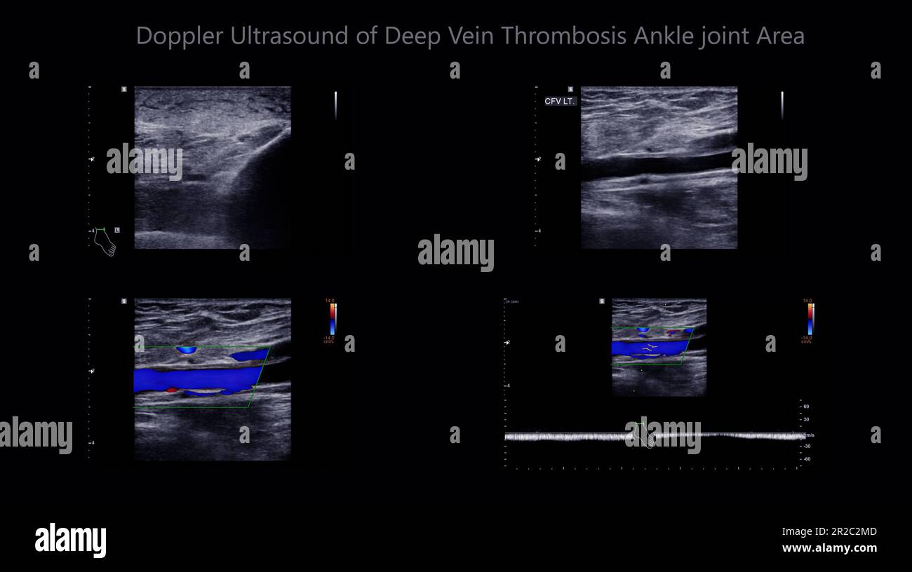 Color Doppler ultrasound determination in deep vein thrombosis patients ...