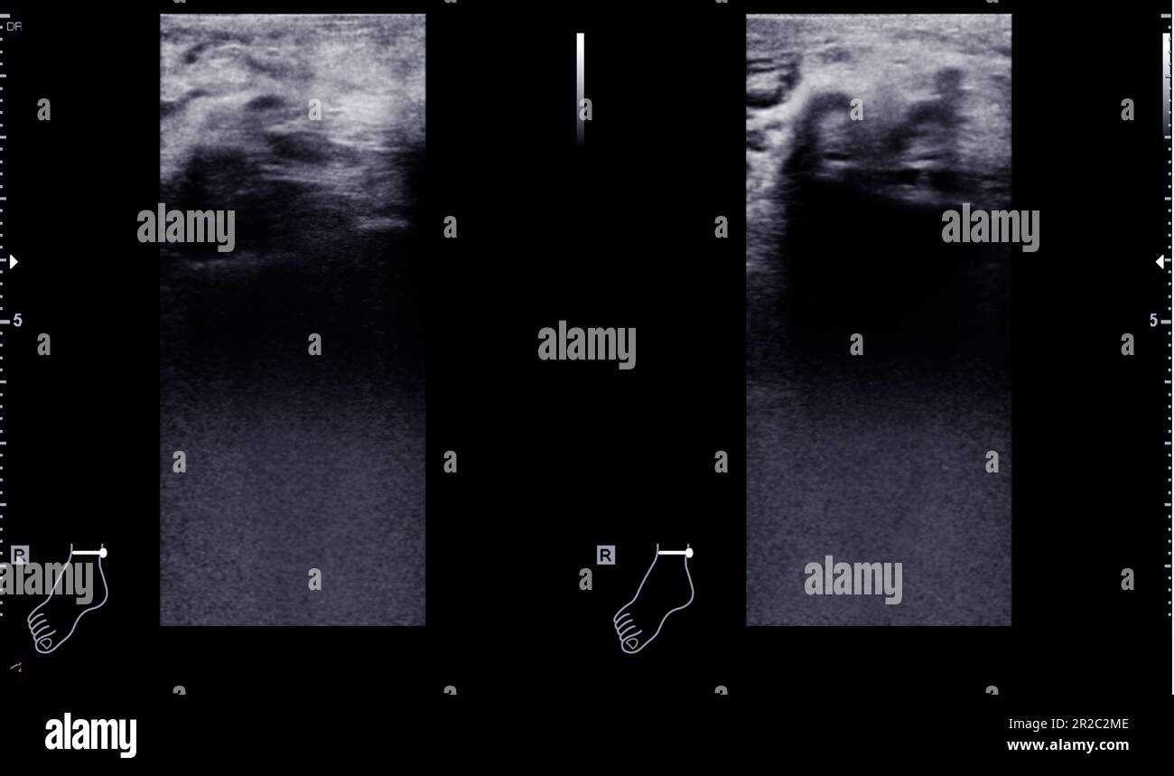 Color Doppler ultrasound determination in deep vein thrombosis patients ...