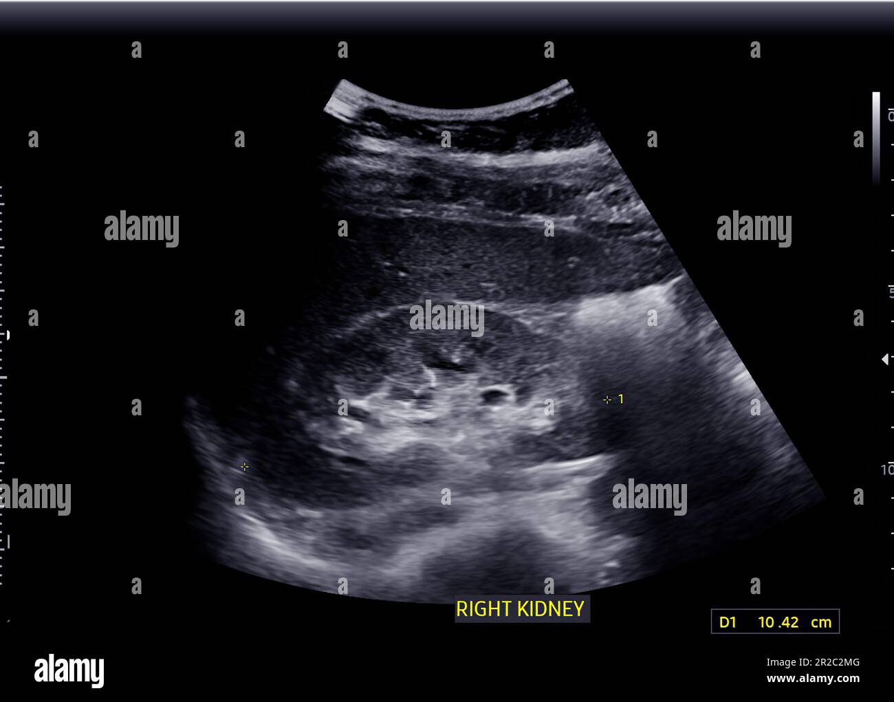 Ultrasound of Kidney or KUB for screening renal stone disease Stock ...