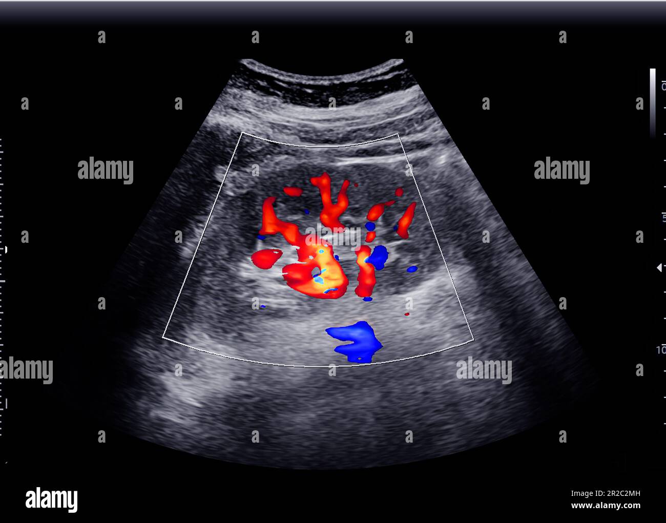 Ultrasound of Kidney or KUB for screening renal stone disease Stock ...