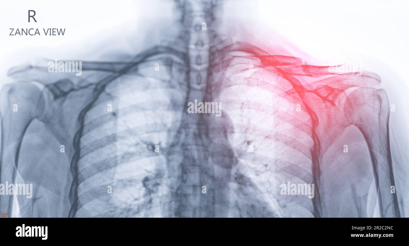Zanca View Chest X Ray at Amy Curley blog