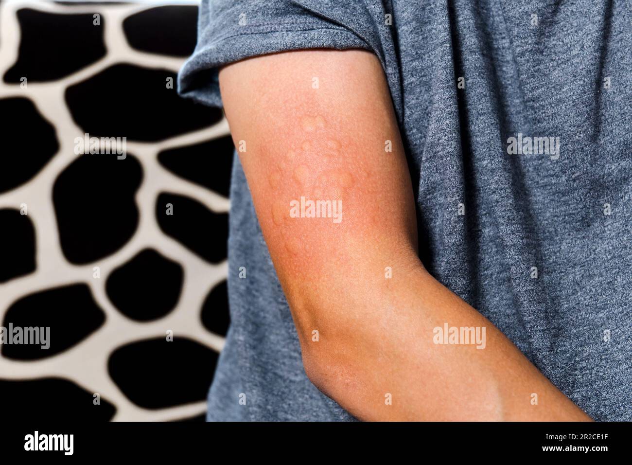 Red rash on skin from allergic reactions. Health care and medical ...