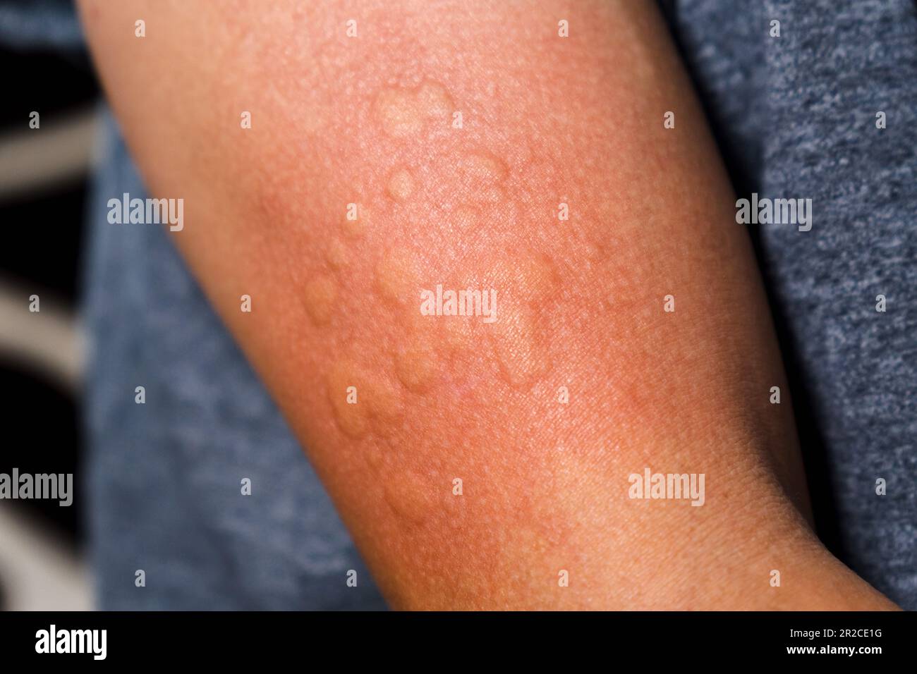 Allergic reaction to injections. Concept treatment skincare. Selective ...