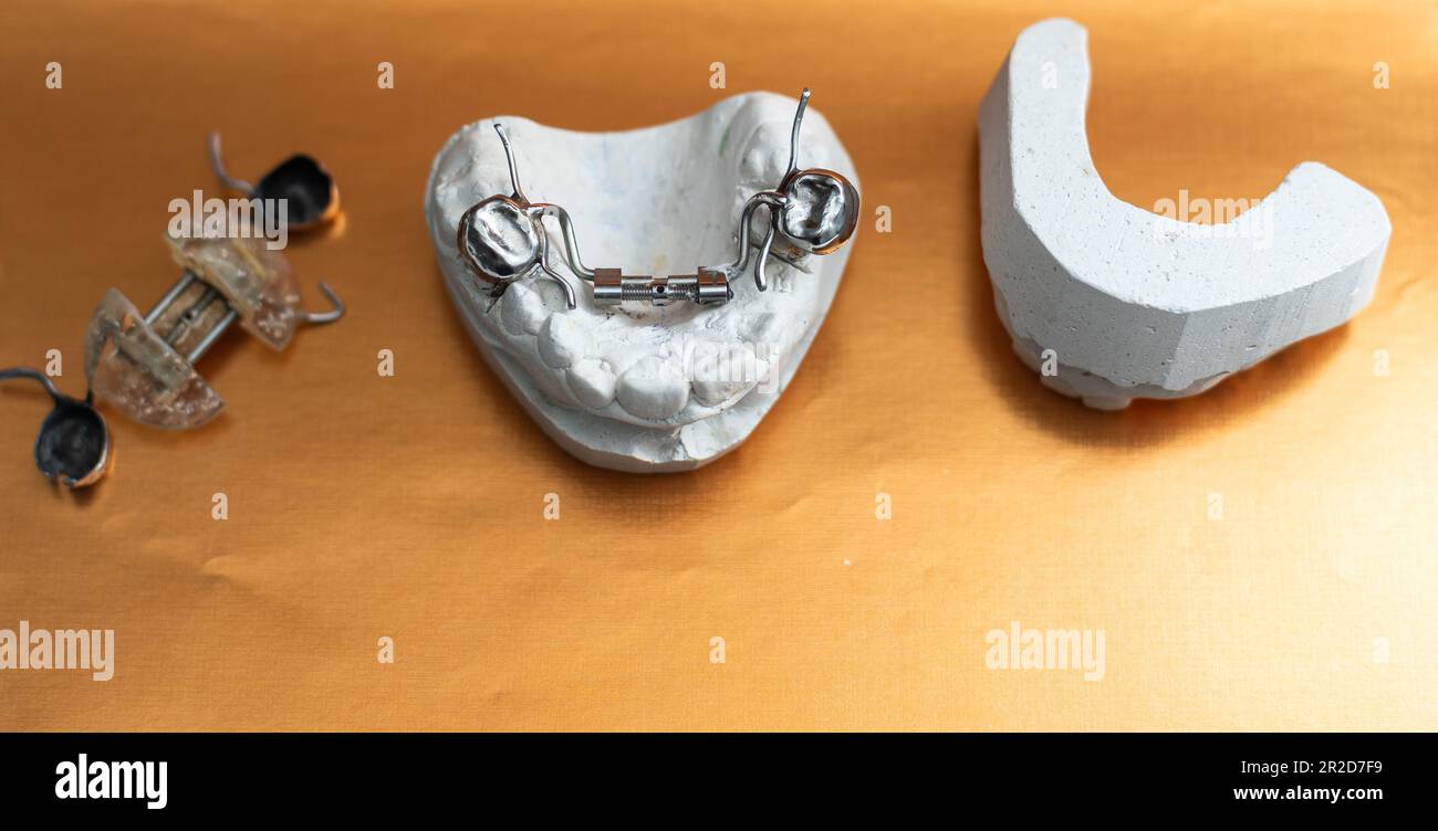 Dental casting gypsum model of human jaws. Crooked teeth and distal ...