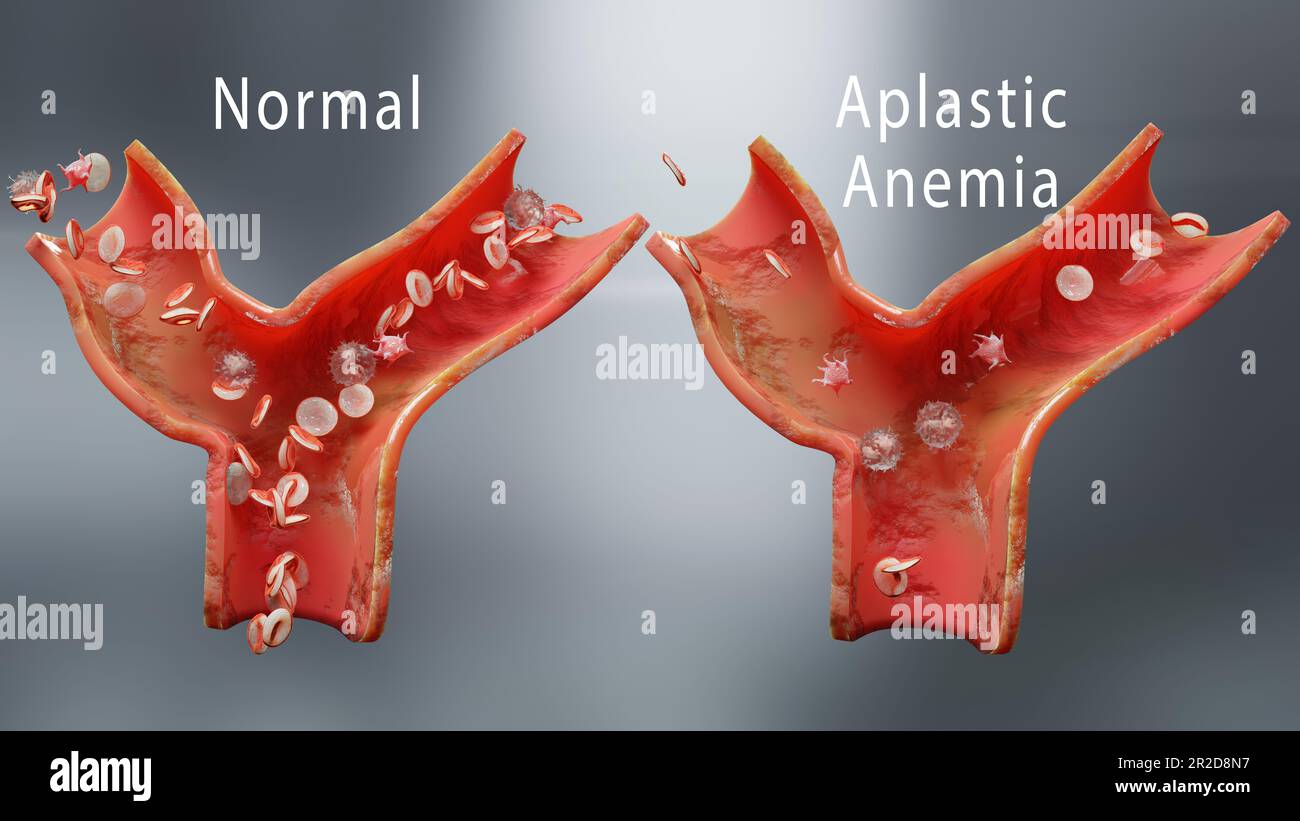Anemia amount of blood cell or hemoglobin and normal. Aplastic anemia ...