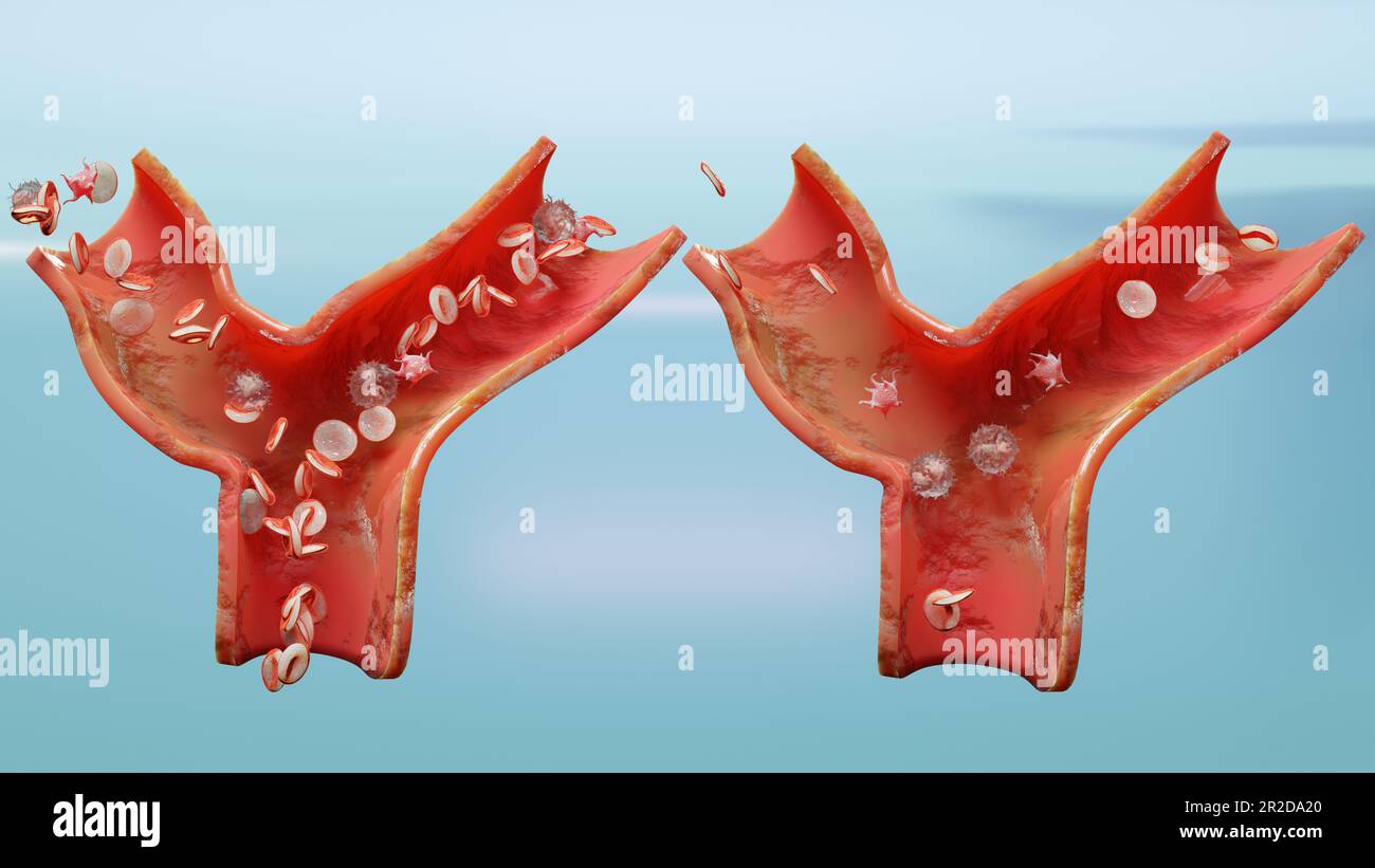 Anemia amount of blood cell or hemoglobin and normal. Aplastic anemia ...