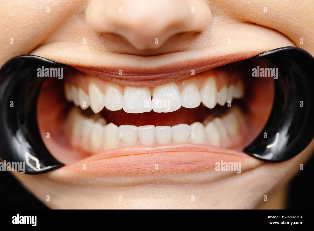 Close up of woman cavity protected by retractor showing perfect teeth ...