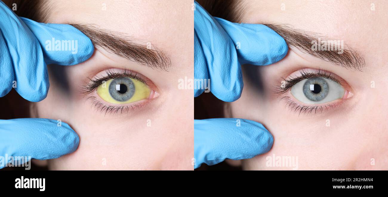 Collage with photos of woman before and after hepatitis treatment ...