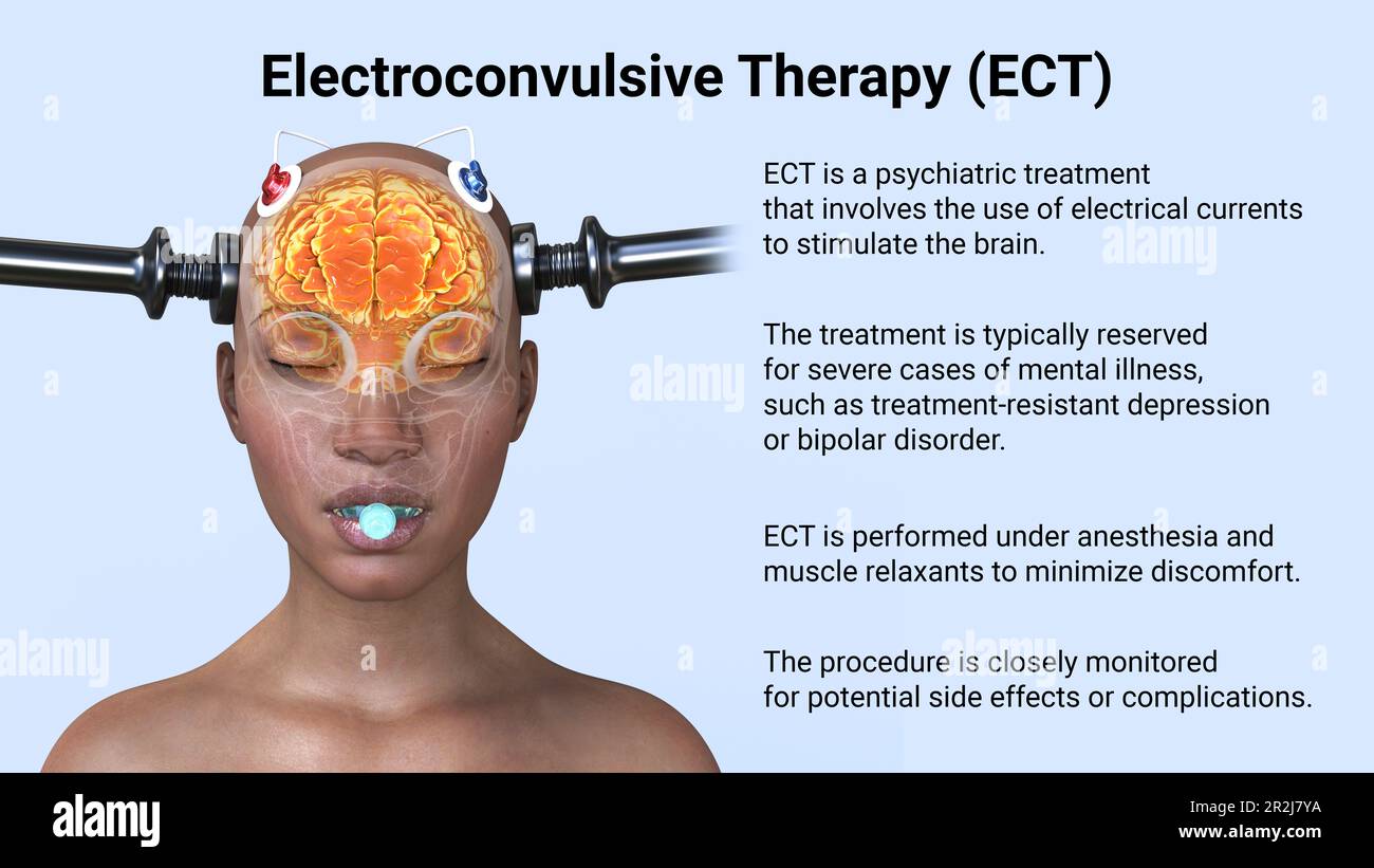 Electroconvulsive therapy, illustration Stock Photo - Alamy
