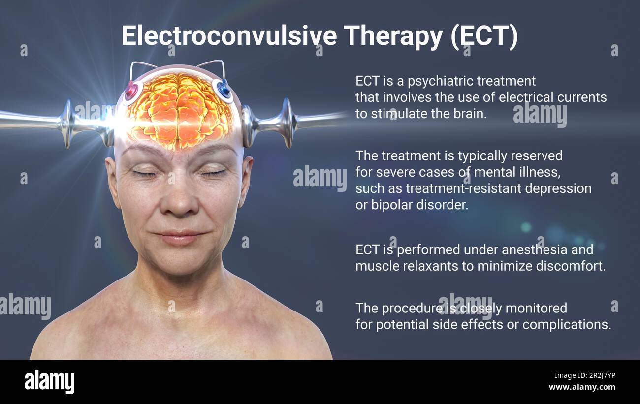 Woman electroconvulsive therapy hi-res stock photography and images - Alamy