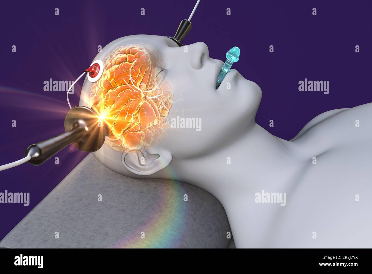 Electroconvulsive therapy, illustration Stock Photo - Alamy