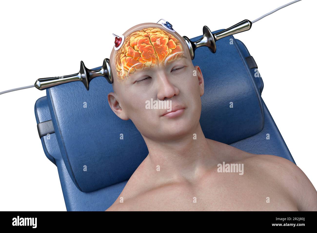 Electroconvulsive therapy, illustration Stock Photo - Alamy