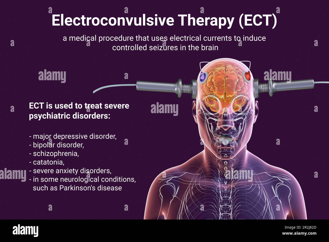 Electroconvulsive therapy, illustration Stock Photo - Alamy