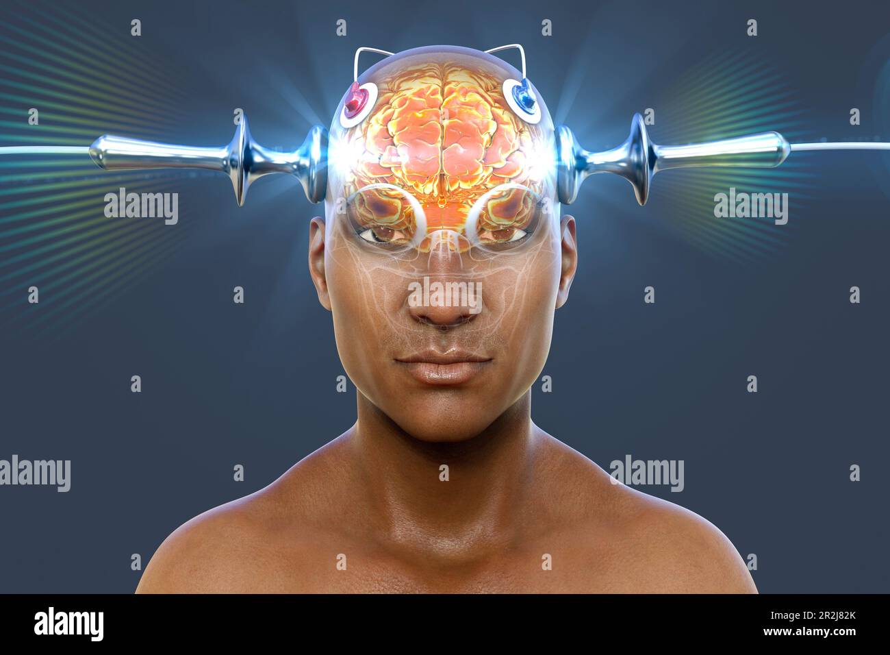 Electroconvulsive therapy, illustration Stock Photo - Alamy