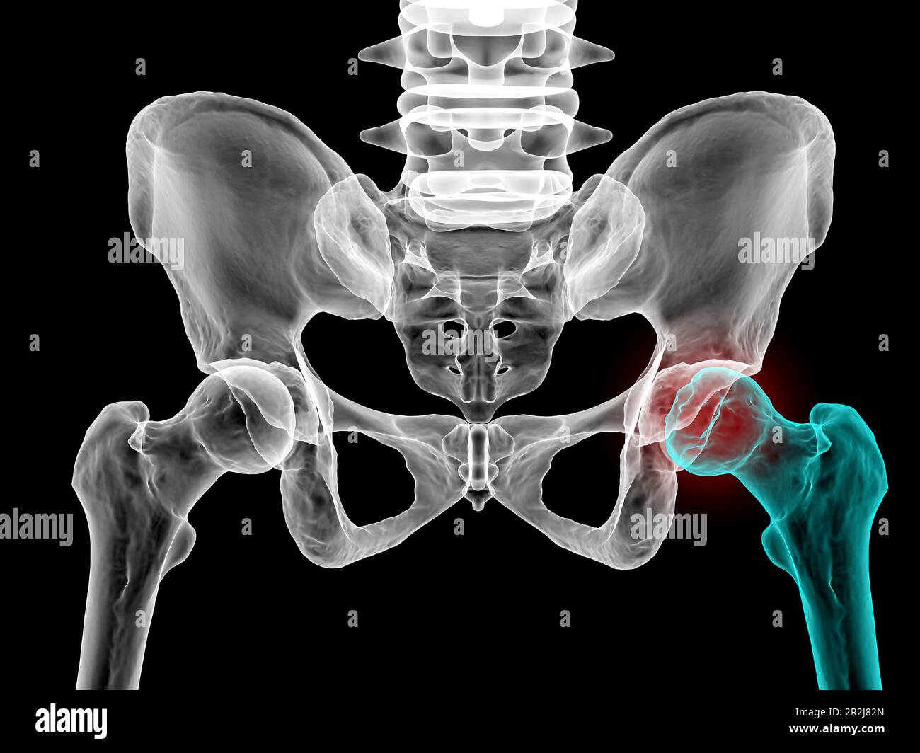 Computer illustration of a left femur bone (right) affected by Legg-Calve-Perthes Disease. This ...