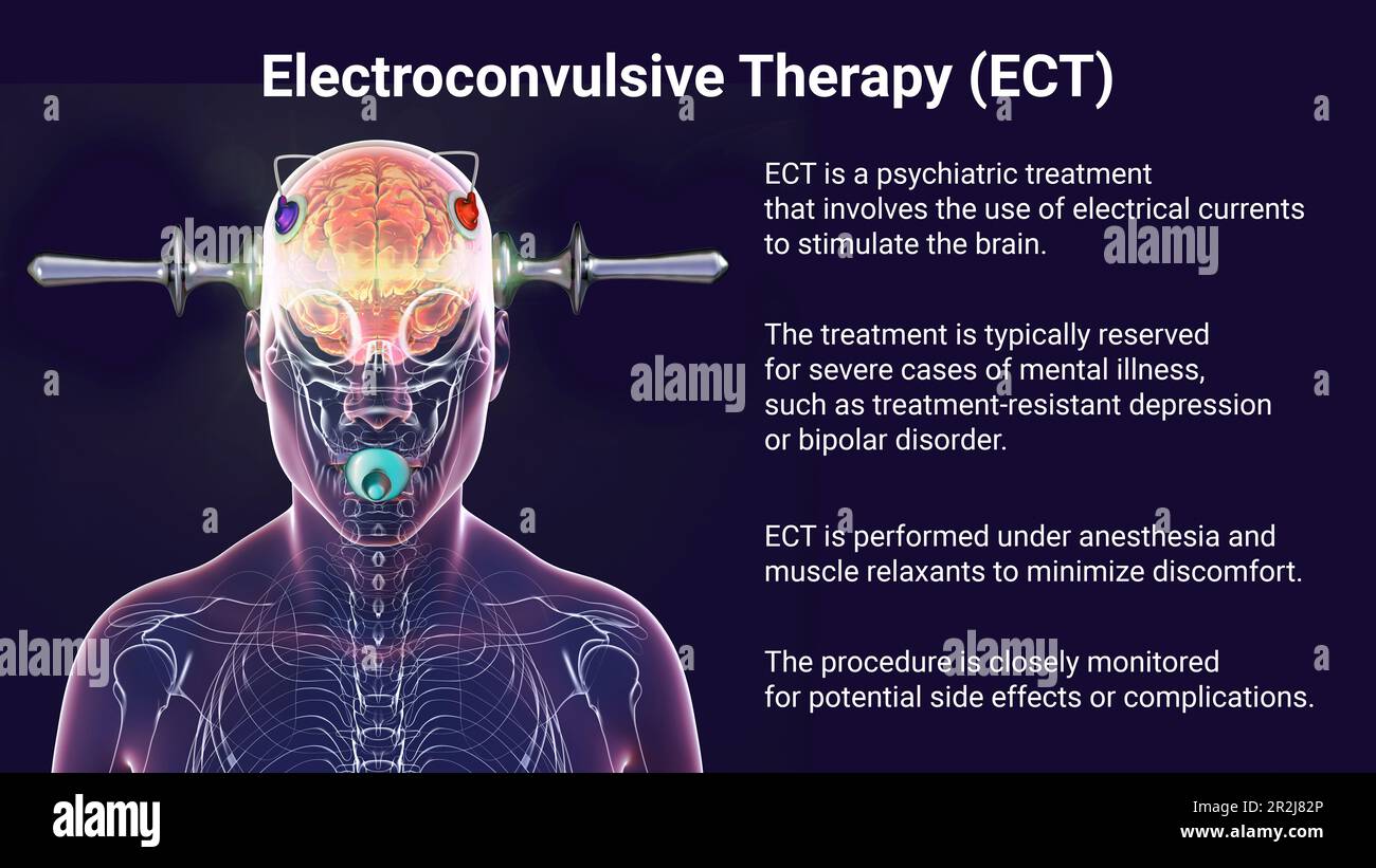 Electroconvulsive therapy, illustration Stock Photo - Alamy