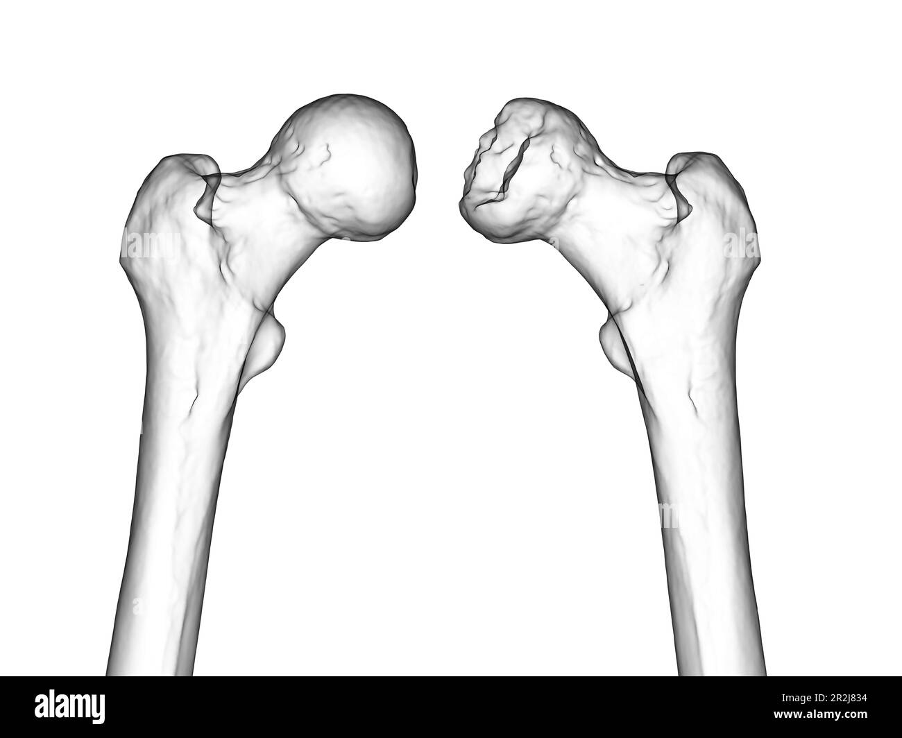 Computer illustration of a left femur bone (right) affected by Legg ...
