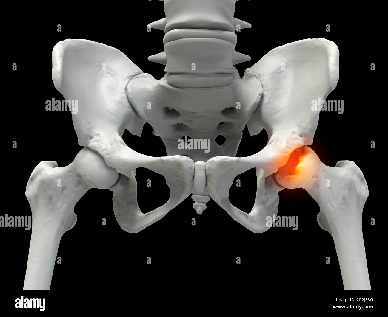 Legg-Calve-Perthes disease, illustration Stock Photo - Alamy