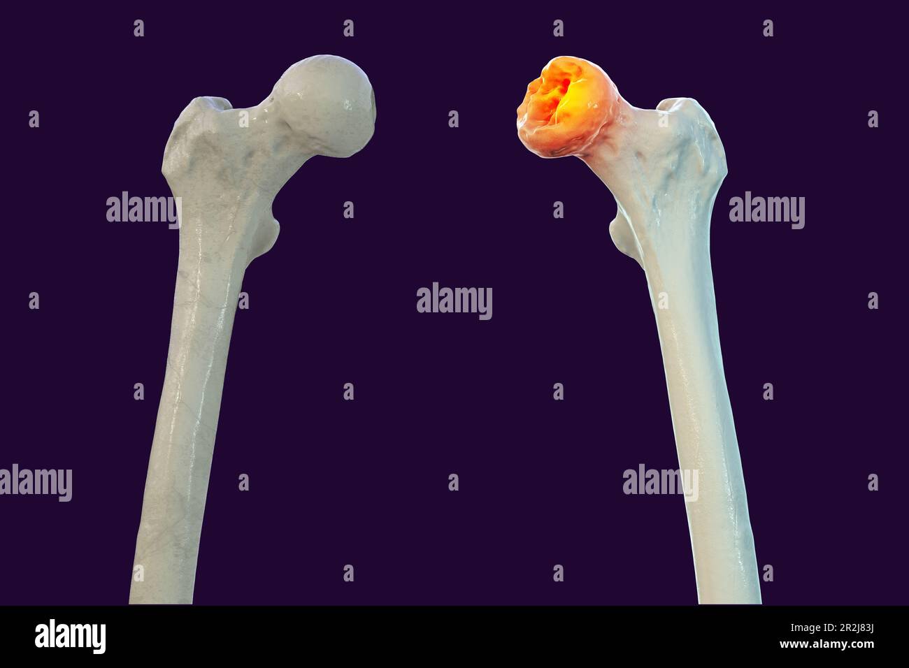 Legg-Calve-Perthes disease, illustration Stock Photo - Alamy