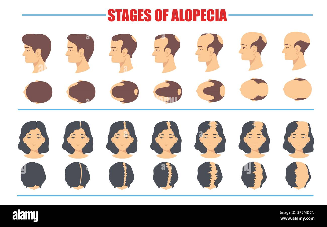 Stages of male and female alopecia vector illustrations set Stock ...