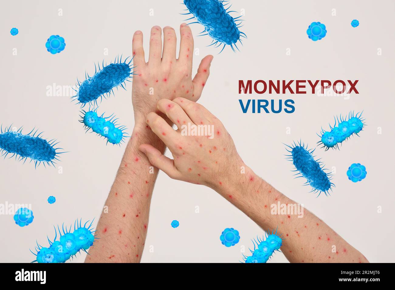Man with rash suffering from monkeypox virus on beige background ...