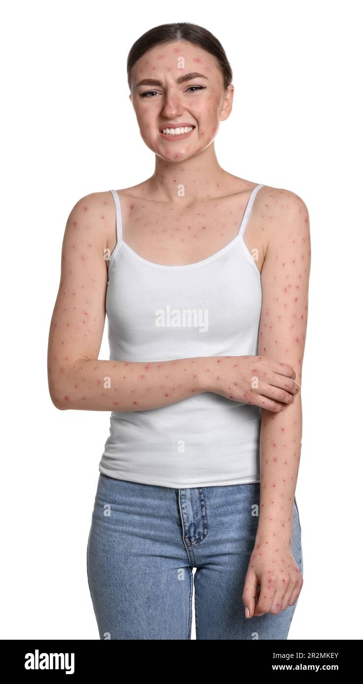 Woman with rash suffering from monkeypox virus on white background ...