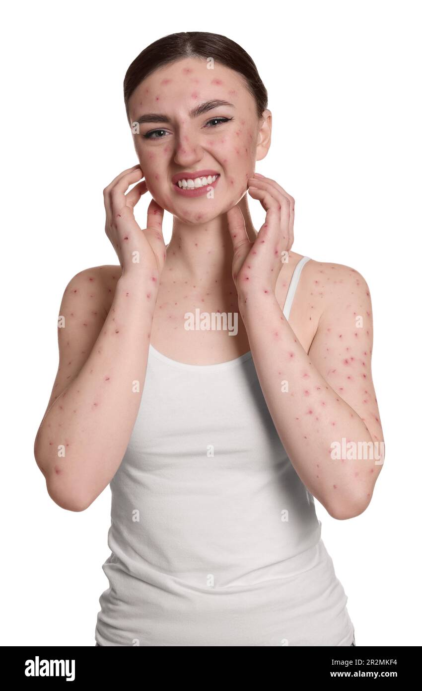 Woman with rash suffering from monkeypox virus on white background ...