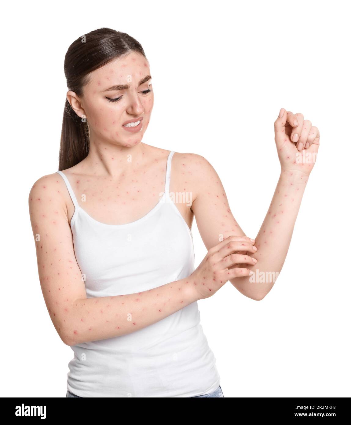 Woman with rash hi-res stock photography and images - Alamy