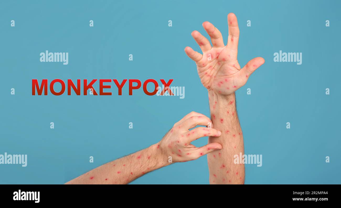 Man with rash from pox virus infection hi-res stock photography and ...