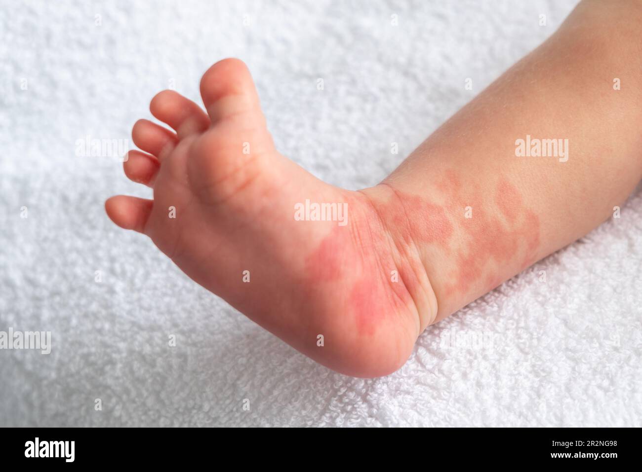 Hemangioma red birthmark on the leg of newborn baby Stock Photo - Alamy