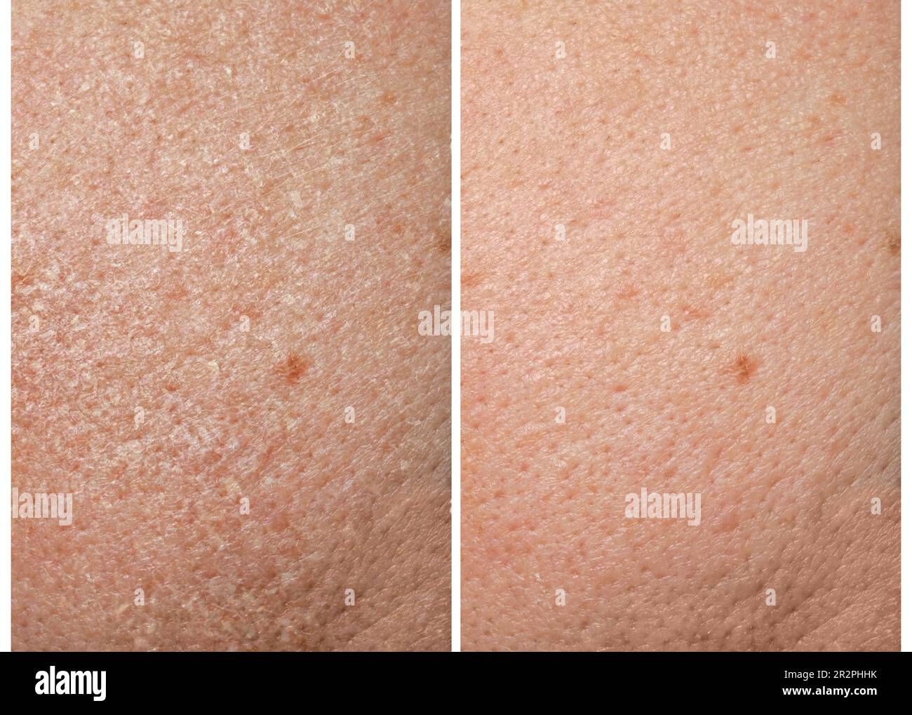 Collage demonstrating comparison of dry and moisturized human skin ...