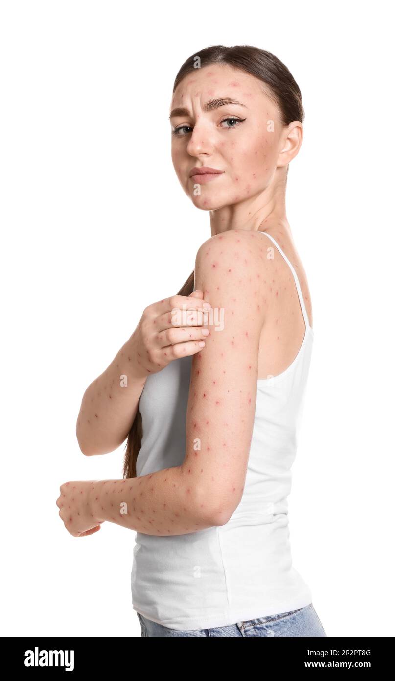 Woman with rash suffering from monkeypox virus on white background ...
