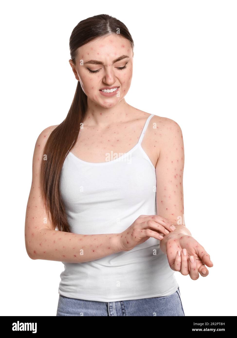Woman with rash suffering from monkeypox virus on white background ...