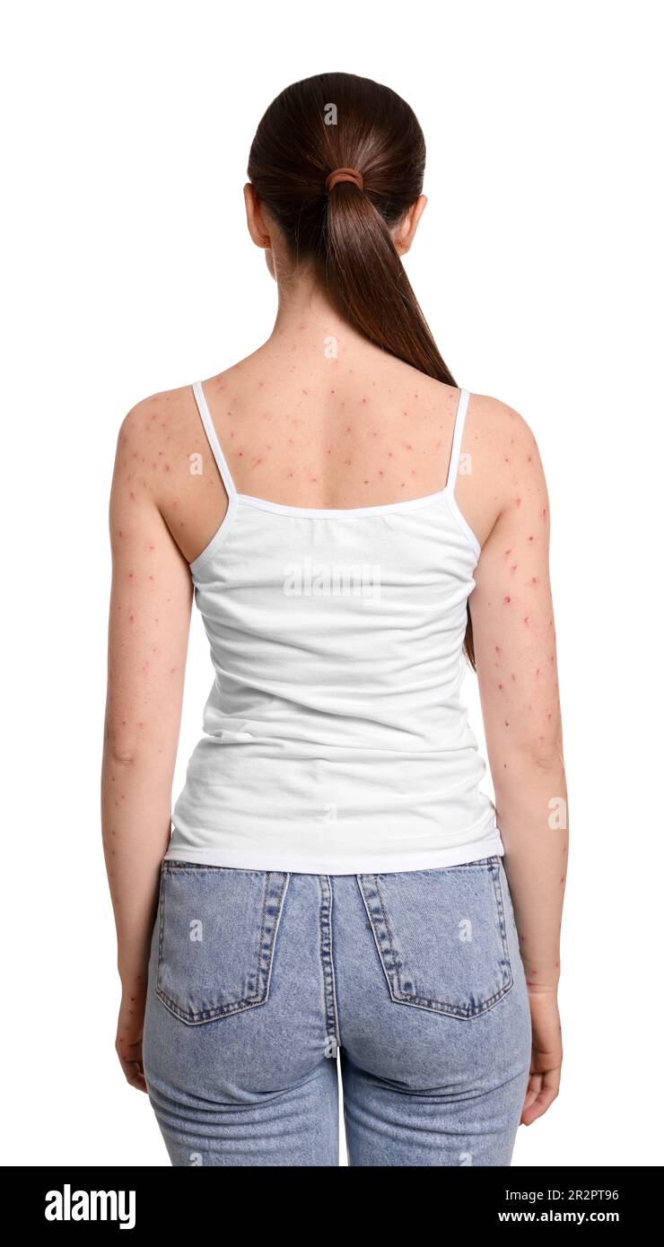 Woman with rash suffering from monkeypox virus on white background ...