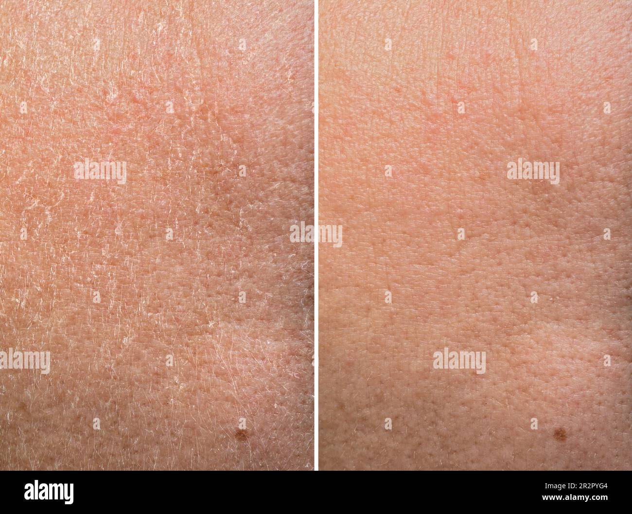Collage demonstrating comparison of dry and moisturized human skin ...