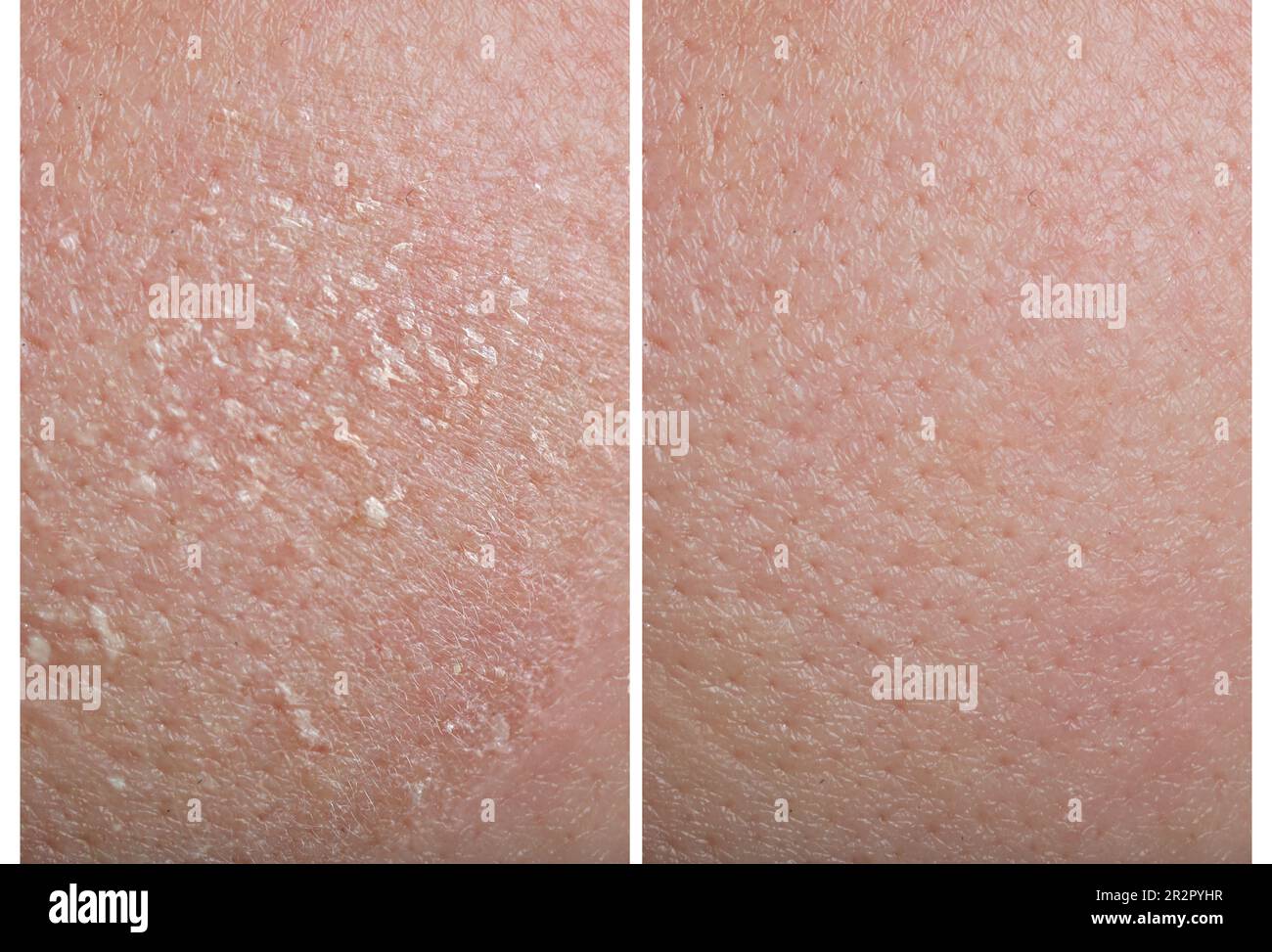 Collage demonstrating comparison of dry and moisturized human skin ...
