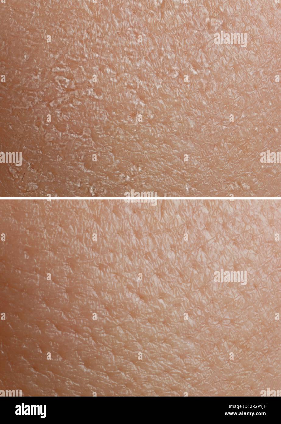 Collage demonstrating comparison of dry and moisturized human skin ...