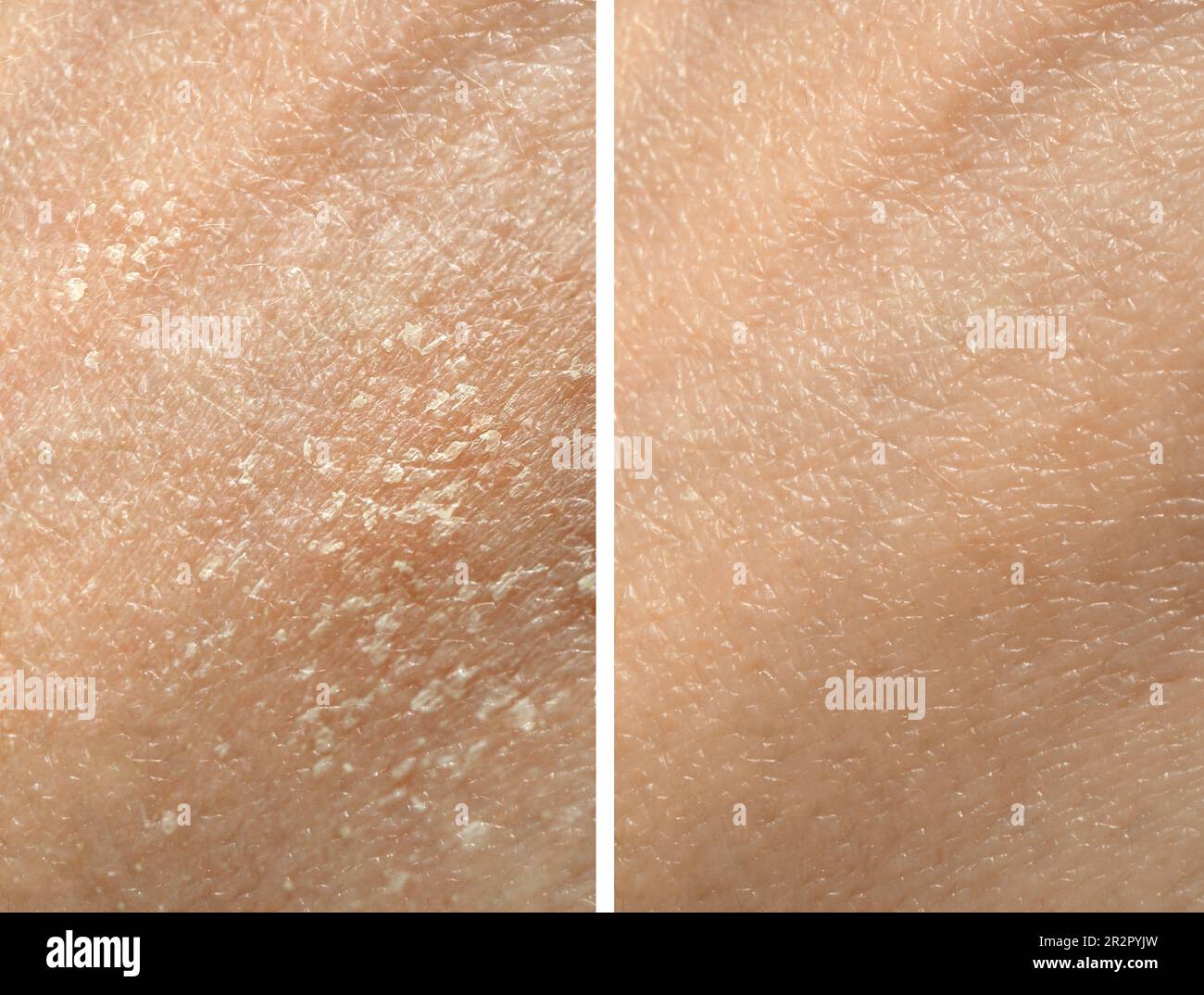 Collage demonstrating comparison of dry and moisturized human skin ...