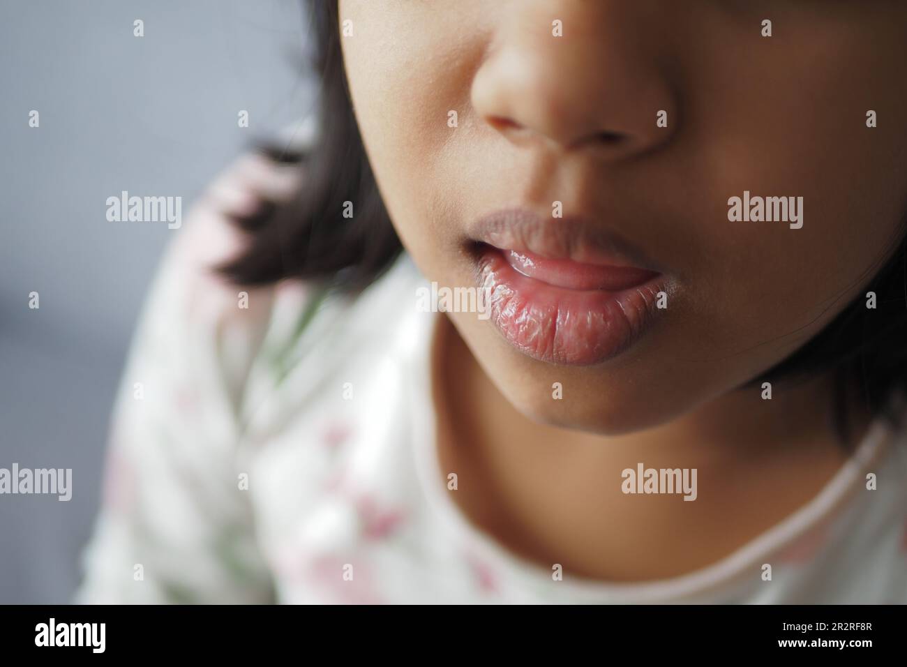 closeup of dry lip of a baby Stock Photo - Alamy