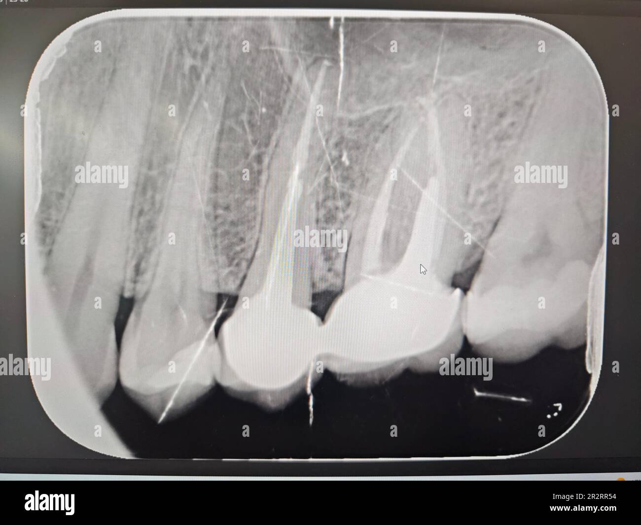 doctor examines a small x-ray picture after the treatment of the ...