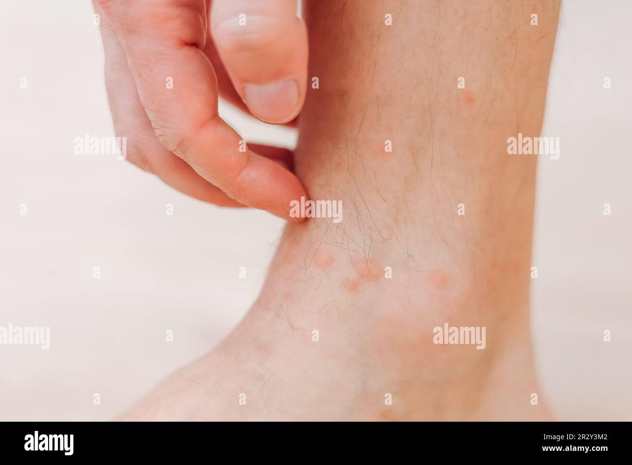 Close up man scratching with hand allergic rash on leg. Leg with red ...